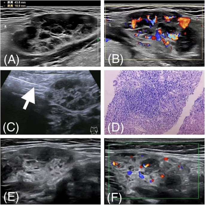 Ultrasonographic features and clinical management of IgG4-related ...