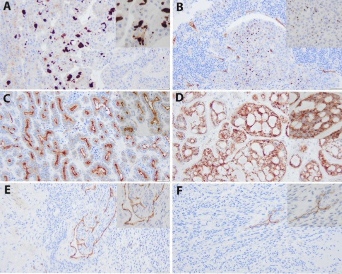 Expression of Prostate-Specific Membrane Antigen in Salivary Gland ...