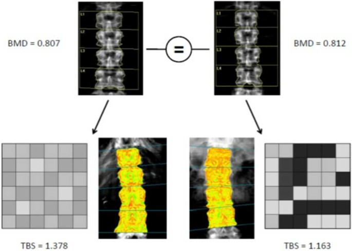 Il ruolo del Trabecular Bone Score (TBS) nella gestione dell ...