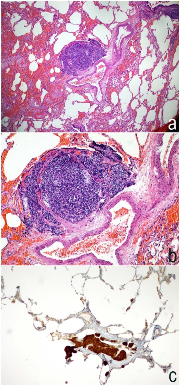 Iperplasia diffusa delle cellule polmonari neuroendocrine (DIPNECH ...