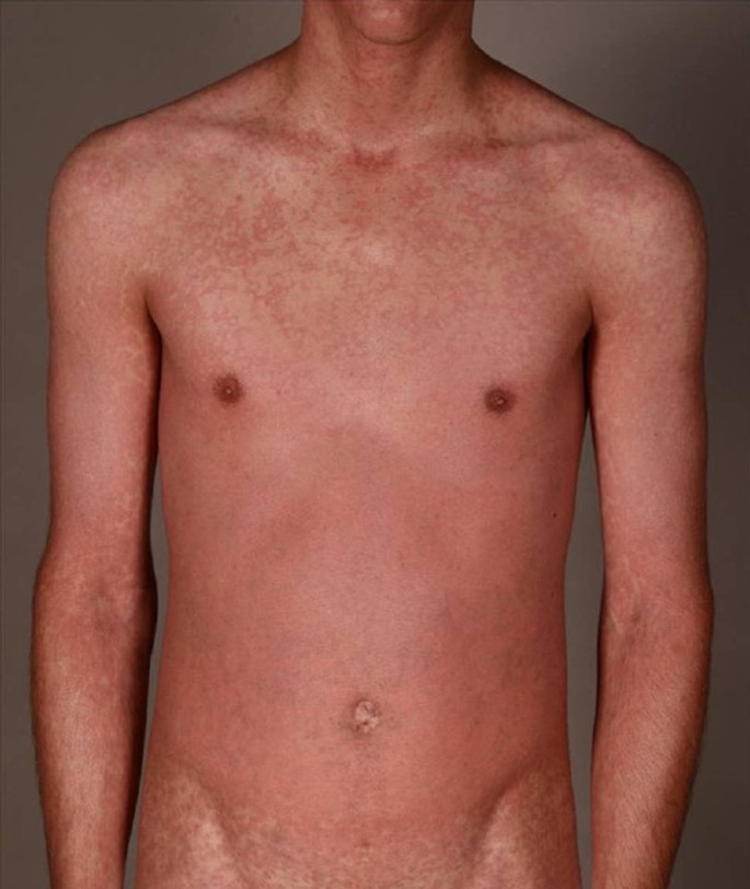 Cutaneous drug reactions: classification, diagnosis, clinical and ...