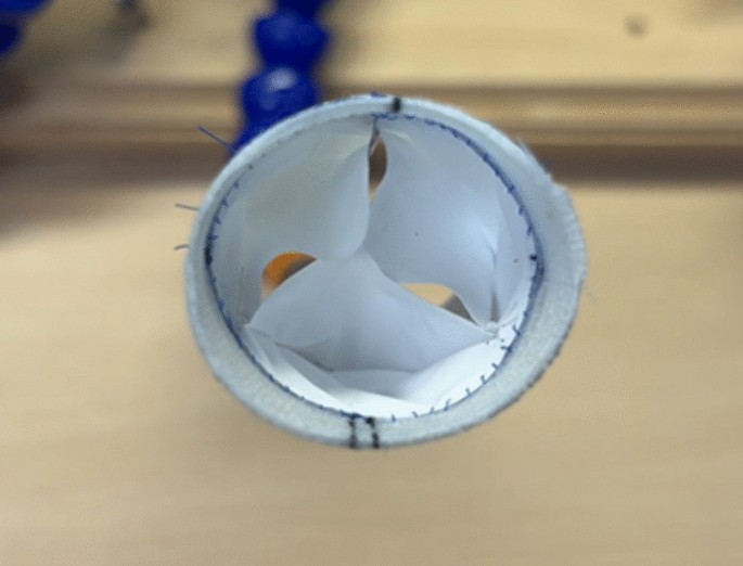 Percutaneous and Surgical Pulmonary Valve Replacement Options in Adult ...