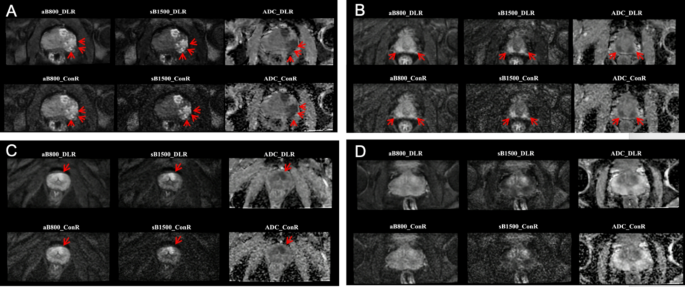 Deep Learning Imaging-Based Reconstruction Improved the Image Quality ...