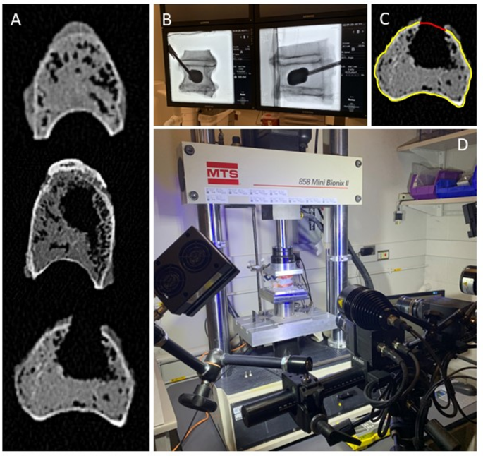 Biomechanical Effects of Defect Size and Location on Vertebral Fracture ...
