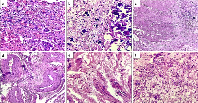 Evaluation of Histomorphological Changes and Chemotherapy Response ...