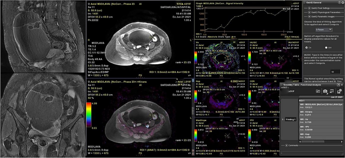 Diagnostic Efficacy of MR Perfusion: Quantitative and Semi-Quantitative ...
