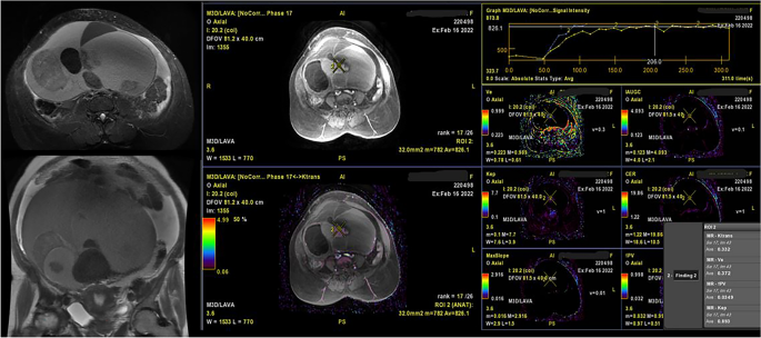 Diagnostic Efficacy of MR Perfusion: Quantitative and Semi-Quantitative ...