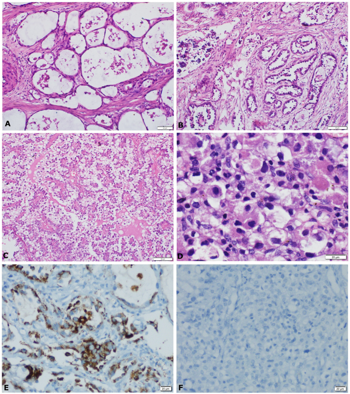 Real-World Insights into Clear Cell Carcinoma of the Cervix: A Single ...