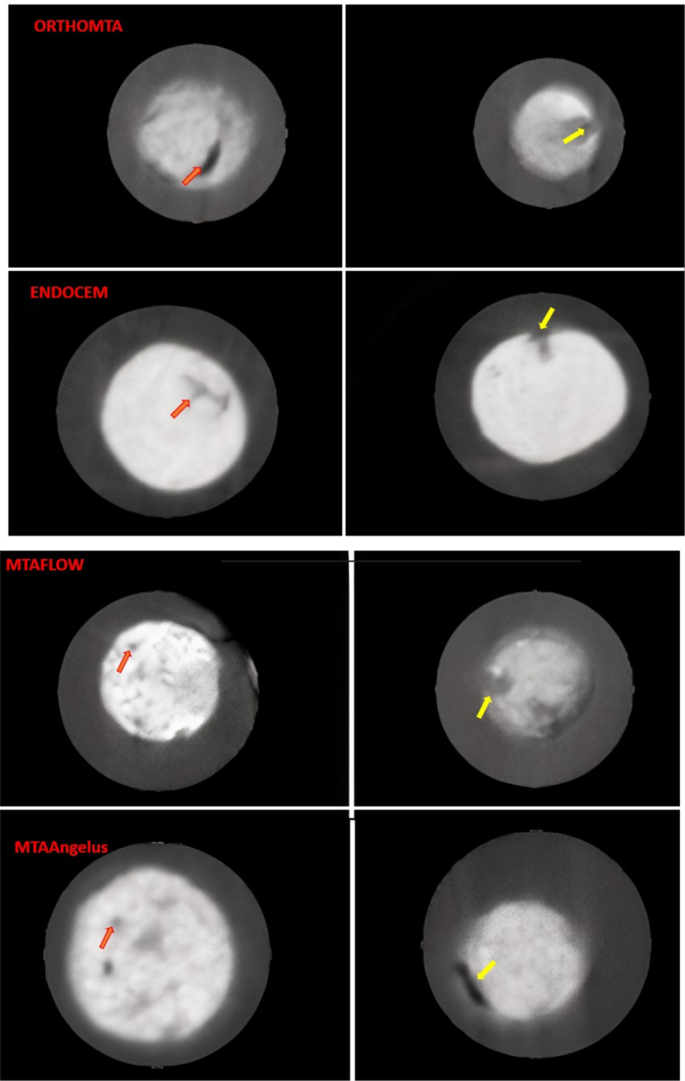 Evaluation of interface gaps and internal voids in MTA-based biomaterials used for apexification ...