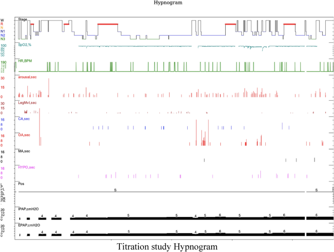 Obstructive Sleep Apnea in an Infant with Suspected Congenital Leptin ...