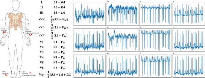 A data-augmented vision transformer model for robust multi-label ECG arrhythmia classification ...