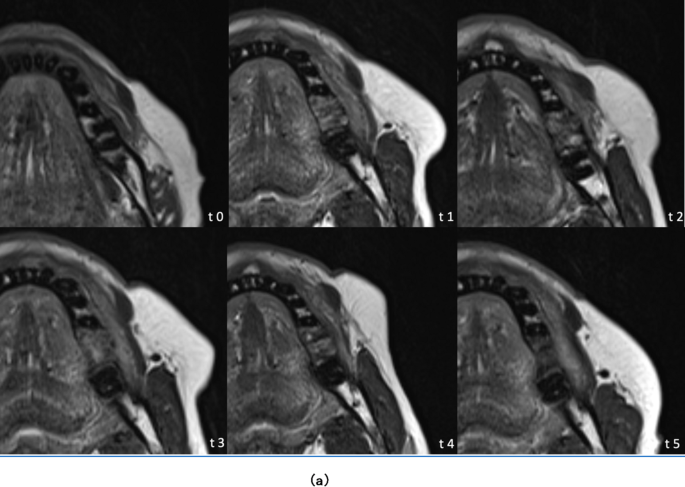 Close-meshed MRIs follow-ups for dynamic healing evaluation after tooth ...