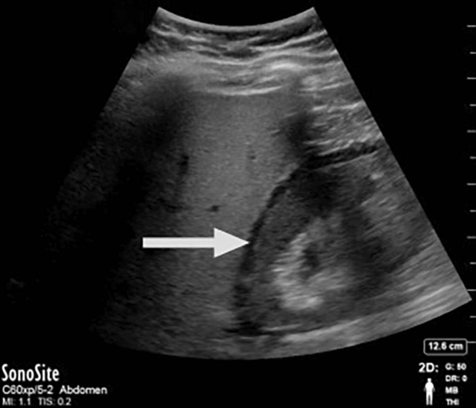 Repetitorium Sonographie der Nieren Teil 2: klinische Anwendung und Krankheitsbilder | Urologie ...