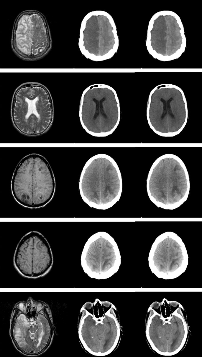 Unsupervised MRI to CT image synthesis using Capsule-CycleGAN | Chinese ...