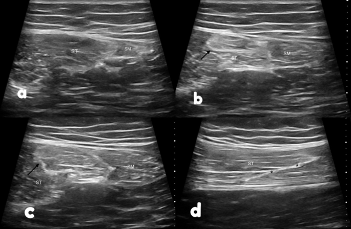 Ultrasound identification of the semitendinosus raphe: a key landmark ...