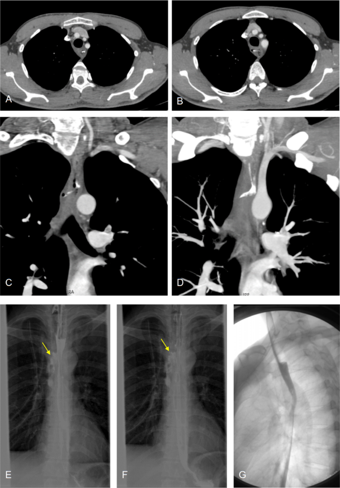 Utilizing CT and fluoroscopic esophagography in inpatients with ...
