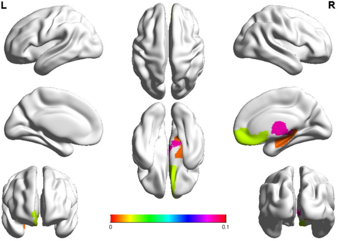 The study of altered brain structure in preterm infants with low grade ...