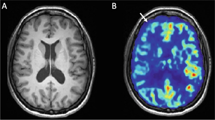 Advanced Magnetic Resonance Imaging Techniques for Epilepsy: A ...