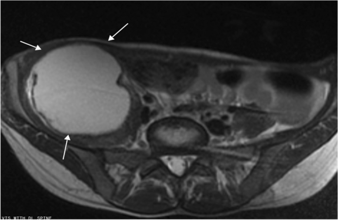 Psoas Abscess with Pott’s Spine: A Case Report | SN Comprehensive ...