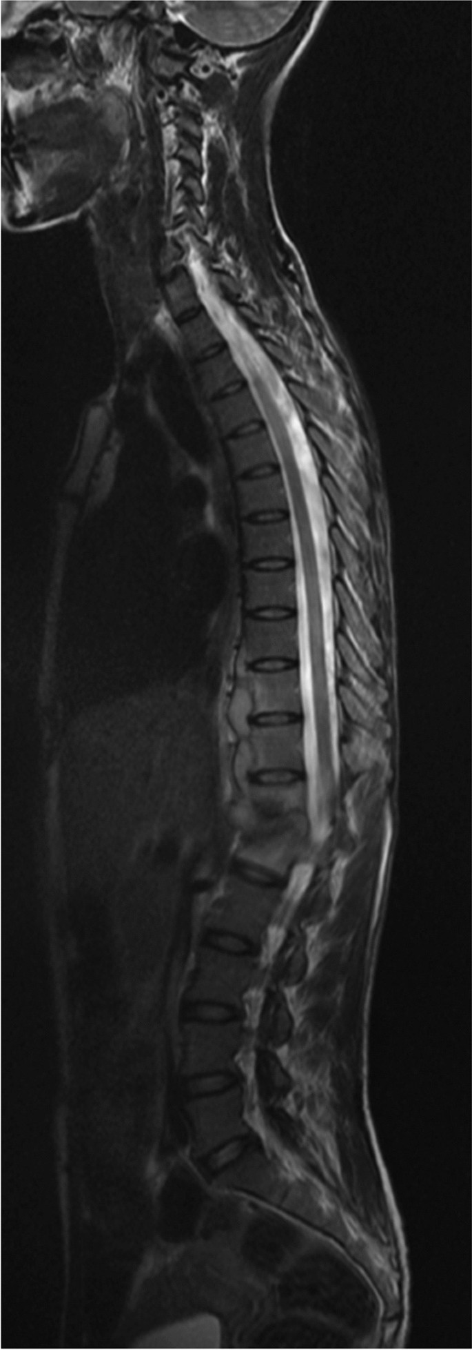 Psoas Abscess with Pott’s Spine: A Case Report | SN Comprehensive ...