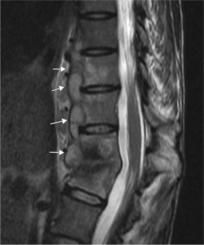 Psoas Abscess with Pott’s Spine: A Case Report | SN Comprehensive ...