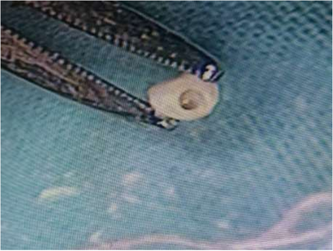 A Comparative Study of Ossicular Reconstruction with TORP/PORP Versus ...