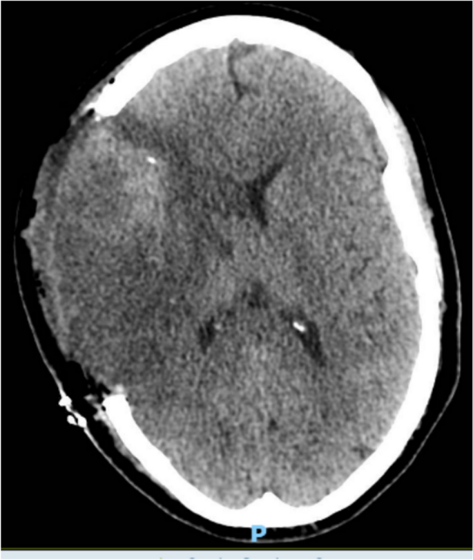 Sinking Skin Flap Syndrome as a Post-craniectomy Complication after ...
