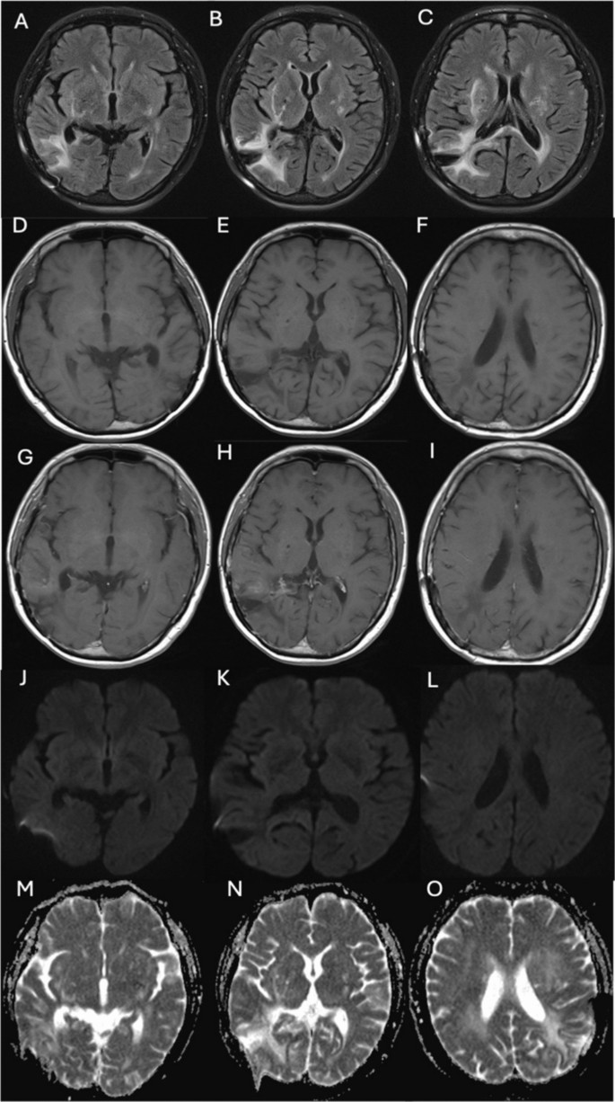 A Case of Recurrent SMART Syndrome—Revisiting the Clinicoradiological ...