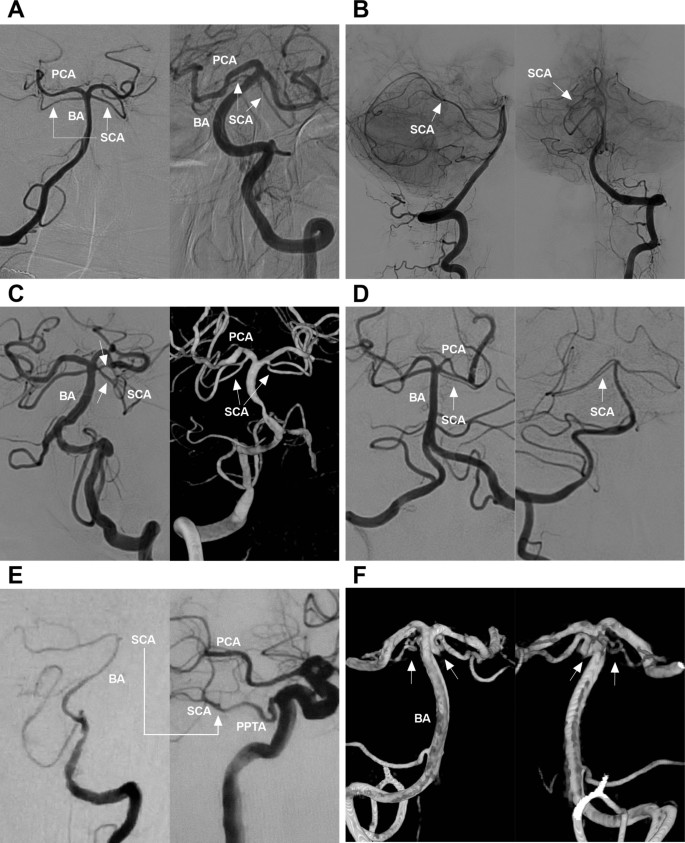 Role of the Superior Cerebellar Artery in the Endovascular Treatment of ...