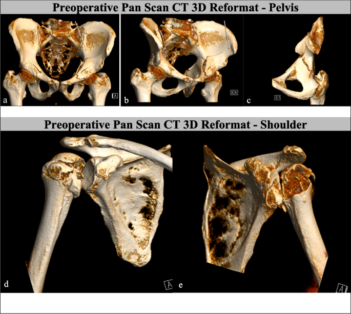 Complex Seizure-Related Multi-Trauma: A Case Report of Severe ...