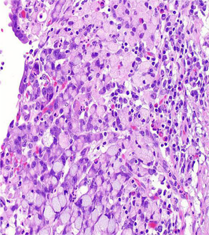 Management of Gastric Stump Carcinoma After Pylorus-Preserving ...