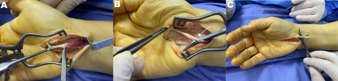Carpal Tunnel Syndrome Caused by Palmaris Profundus: Case Report and ...