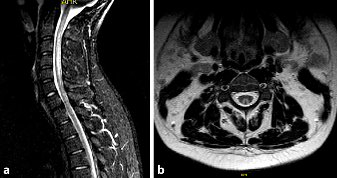 21-jähriger Patient mit ataktischer Gangstörung und Tetraparese ...