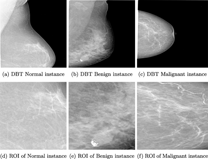 Leveraging Quantum Kernel Support Vector Machine for breast cancer ...