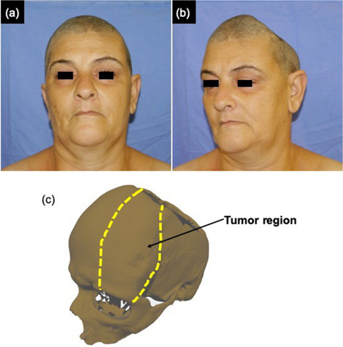 Frontal bone tumor resection and parietal bone defect repair with ...