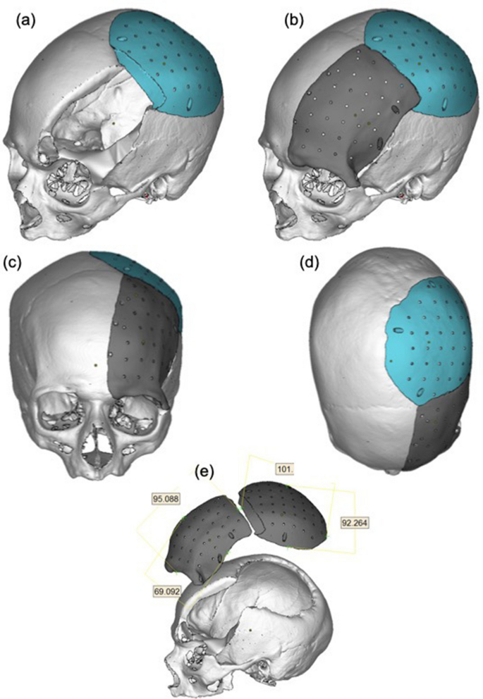 Frontal bone tumor resection and parietal bone defect repair with ...