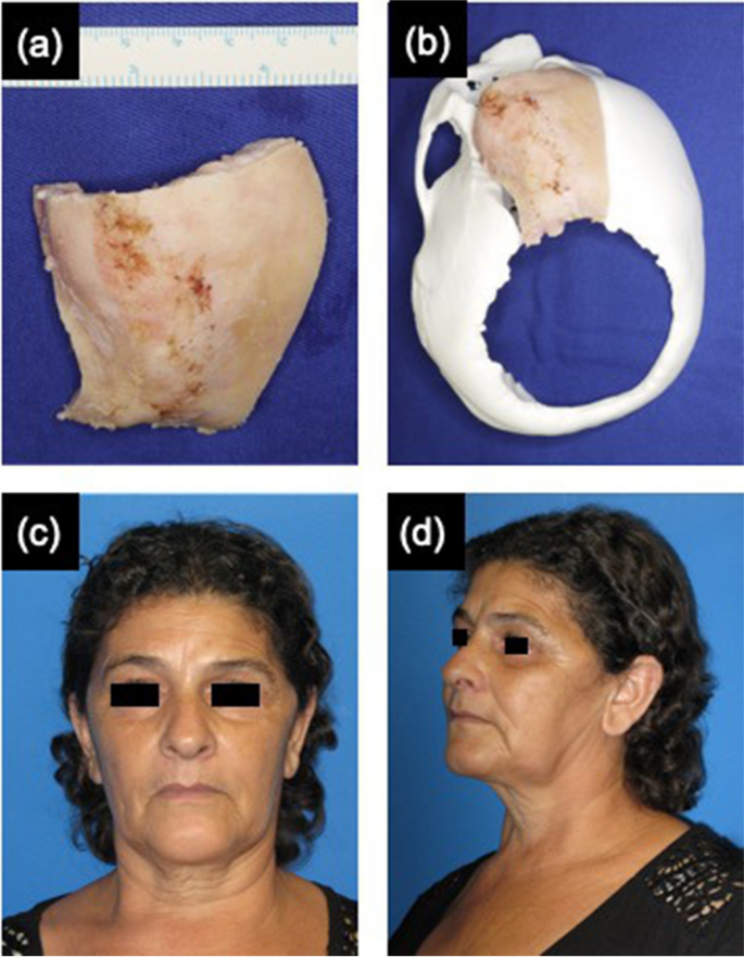 Frontal bone tumor resection and parietal bone defect repair with ...