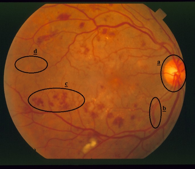 Collation of a Few Retinal Vessel Segmentation Techniques: Is the ...
