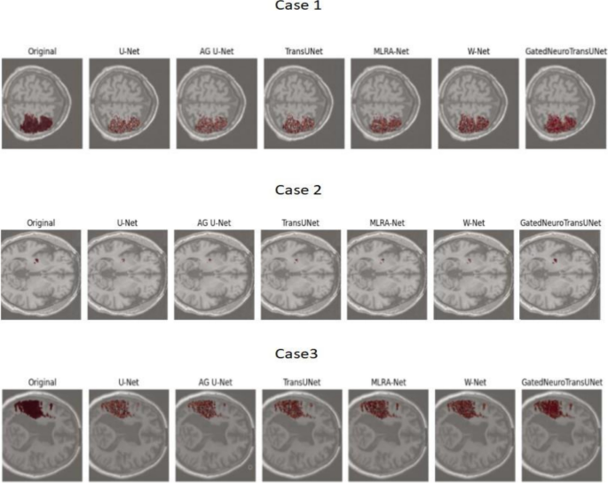 Adaptive Neuro Transformers for Stroke Lesion Segmentation ...