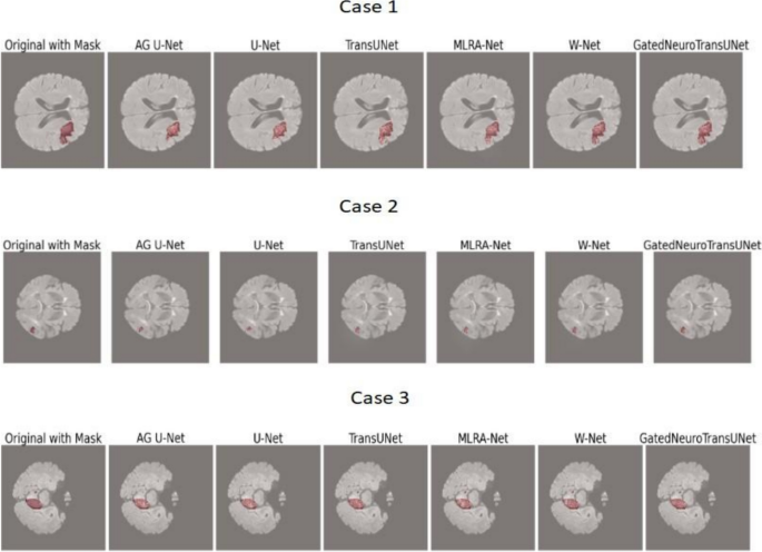 Adaptive Neuro Transformers for Stroke Lesion Segmentation ...
