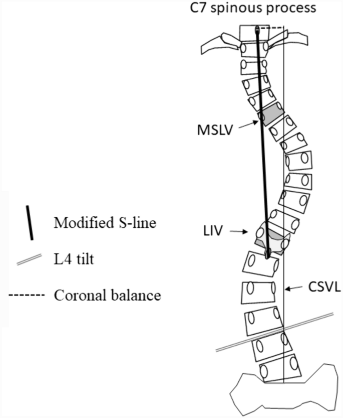 Usefulness of modified S-line for upper instrumented vertebra selection ...
