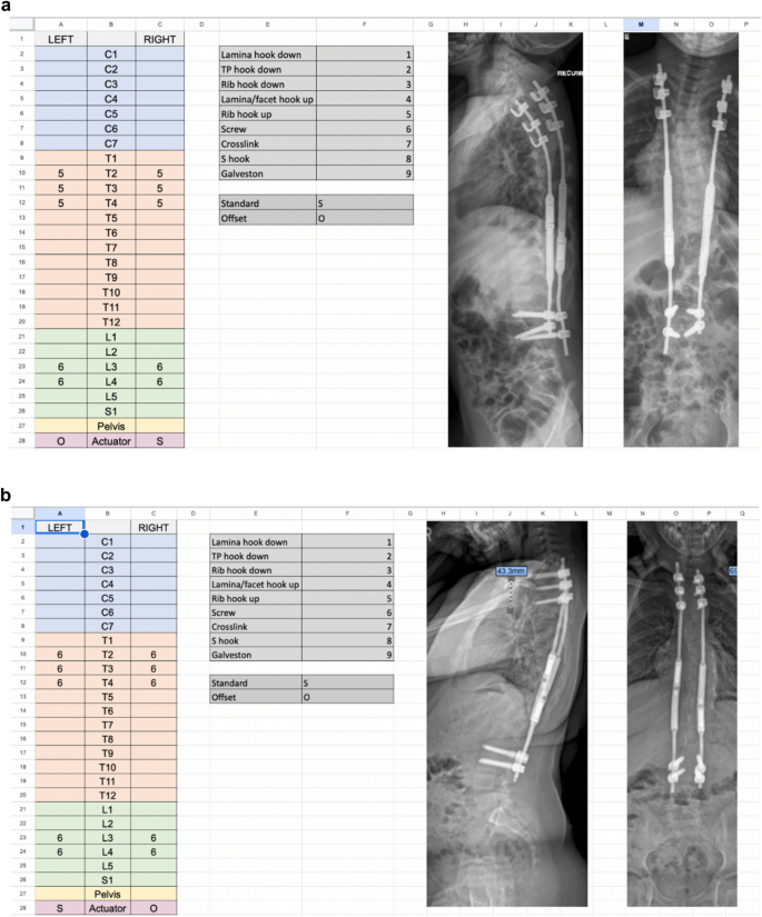 Proximal foundation anchor variations and their correlation with ...