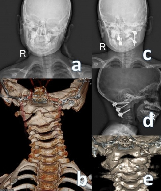 Reliability and validity of the pediatric adaptation of the mJOA scale ...