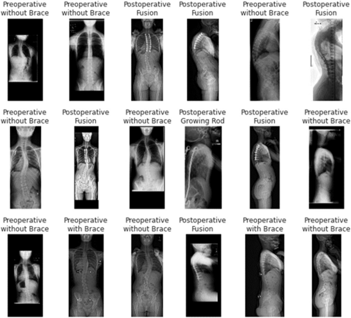 Deep learning classification of pediatric spinal radiographs for use in ...