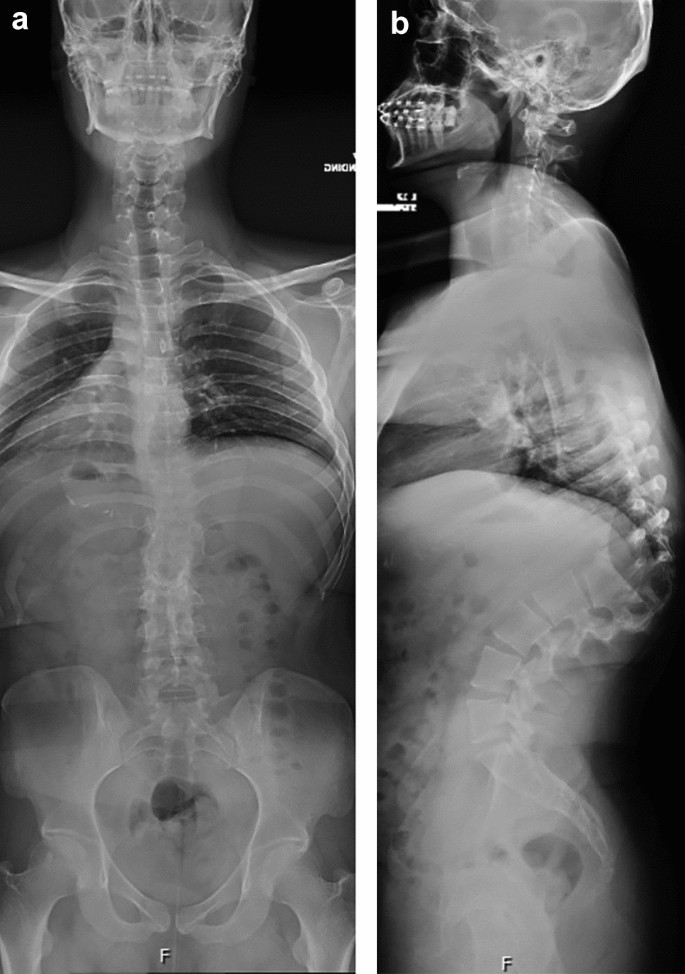 Closing–opening vertebral column resection for thoracolumbar congenital ...