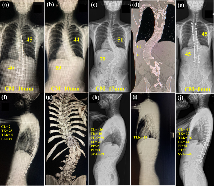 Three cases of revision surgery for exacerbated deformity due to long ...