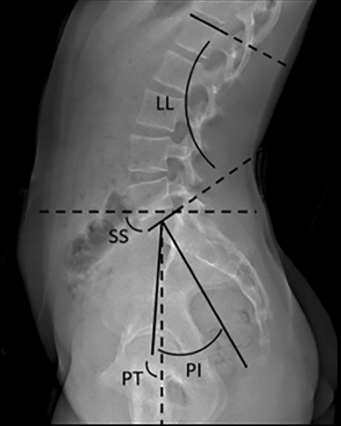 Spinopelvic alignment and sagittal gait kinematics of adult patients ...