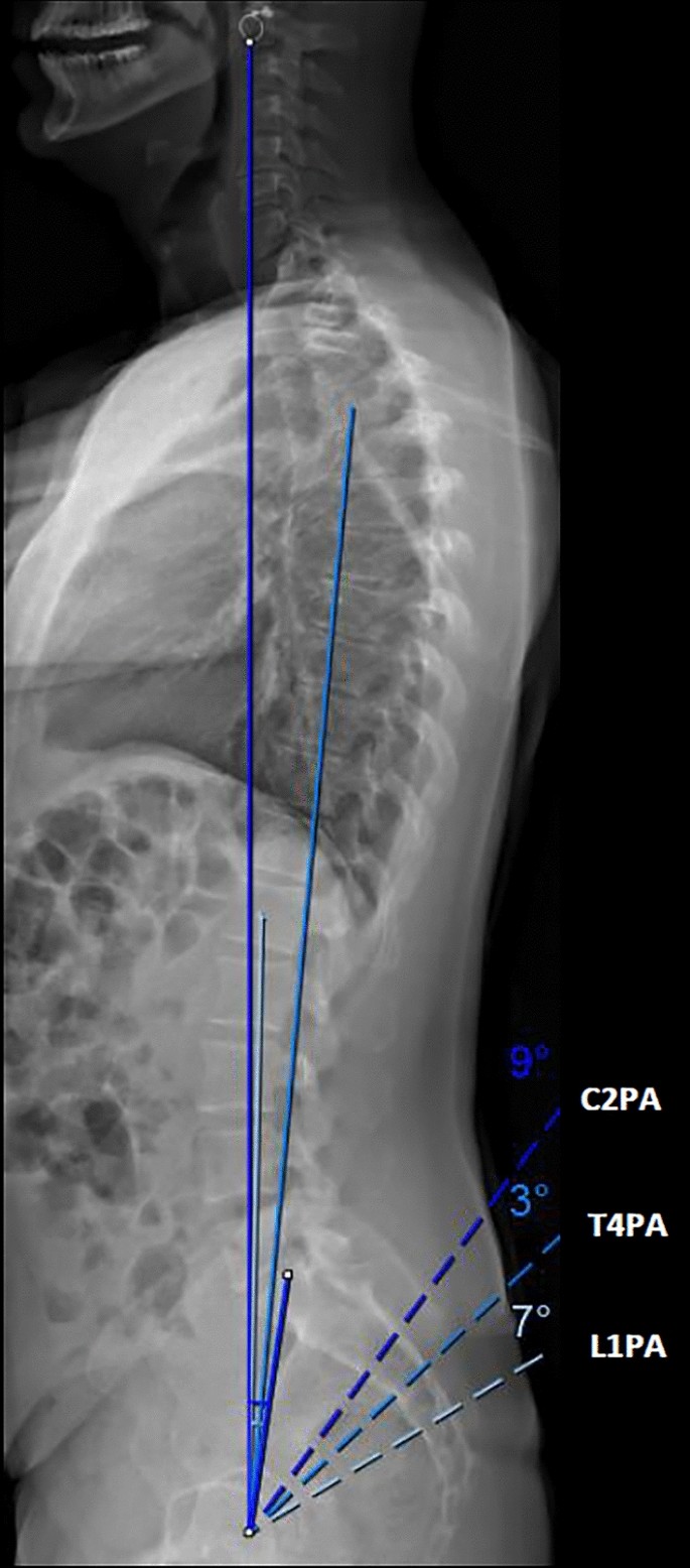 Spinopelvic alignment and sagittal gait kinematics of adult patients ...