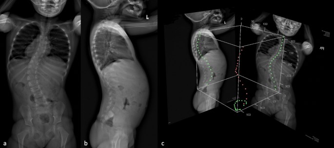 Modern Luque Trolley technique in the surgical management of early ...