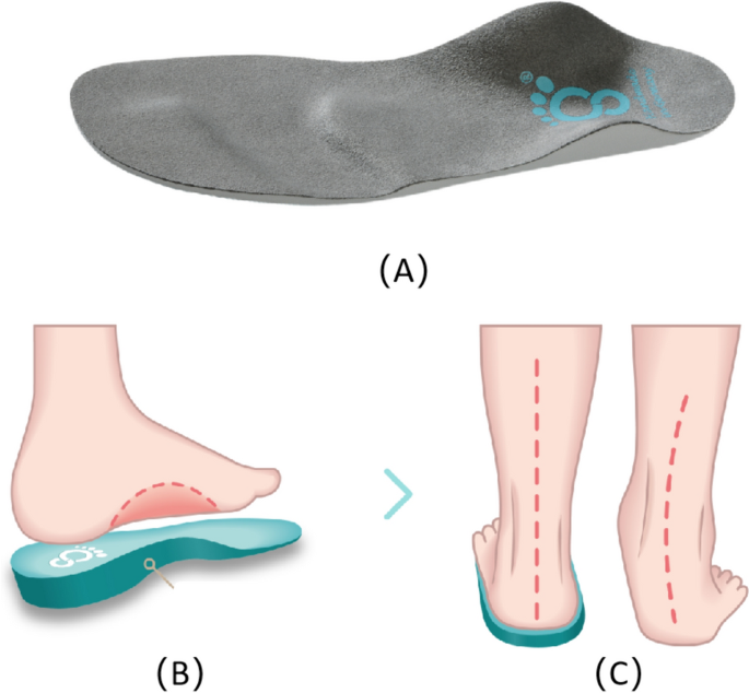 Four-Year Treatment Effect of Custom-Made Foot Orthosis on Pediatric ...